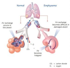 COPD | Resources - Chronic Obstructive Pulmonary Disease